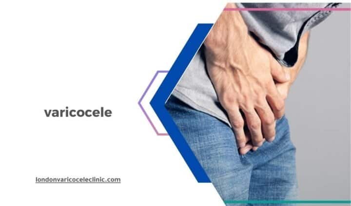 Treating Varicocele Without Surgery Exploring Your Options London